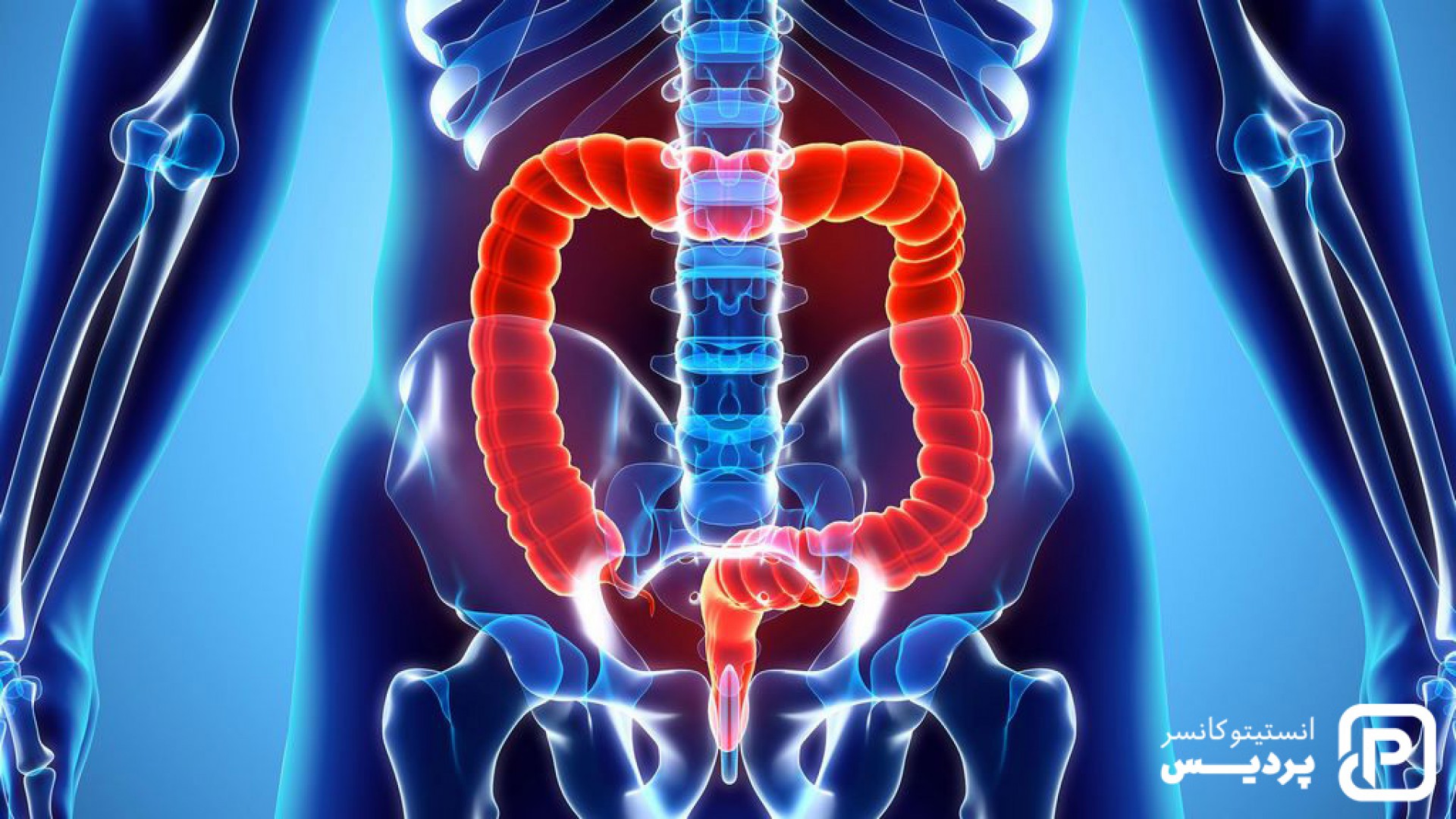 علائم سرطان روده چیست؟ [علائم اولیه تا علائم هشدار دهنده] پردیس